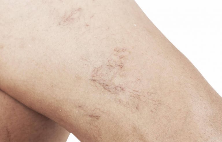 Thread Veins | True You Skin Clinics